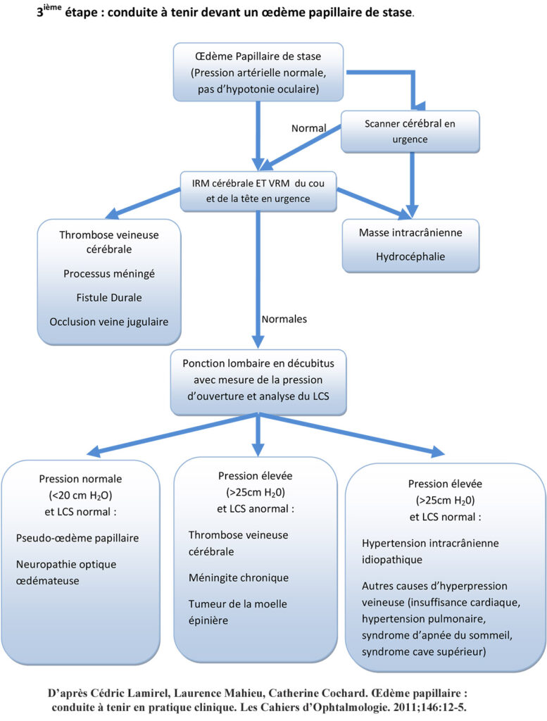 Conduite à tenir devant un œdème papillaire de stase – Club de Neuro ...